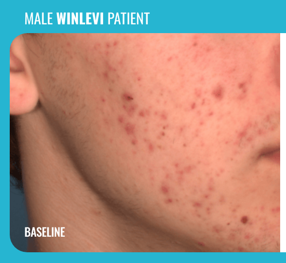 Number 1 Acne Topical - Winlevi