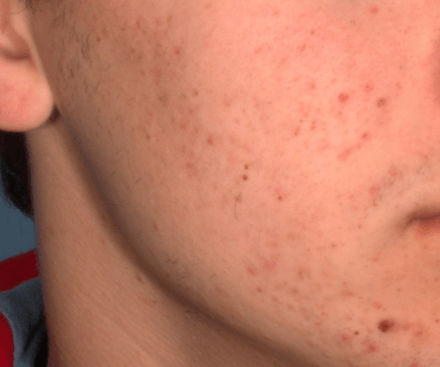 What is WINLEVI®? | WINLEVI®