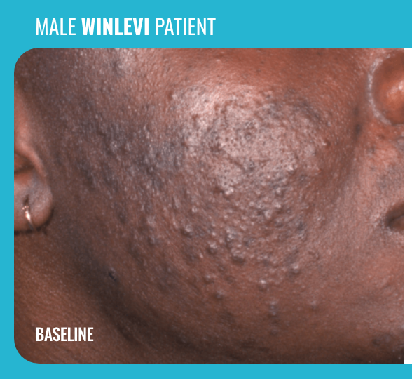Number 1 Acne Topical - Winlevi