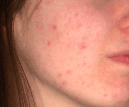 What is WINLEVI®? | WINLEVI®